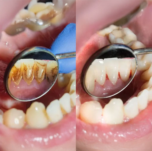 Deep Cleaning(Scaling & Root Planing) -Downtown Clinic-Dubai